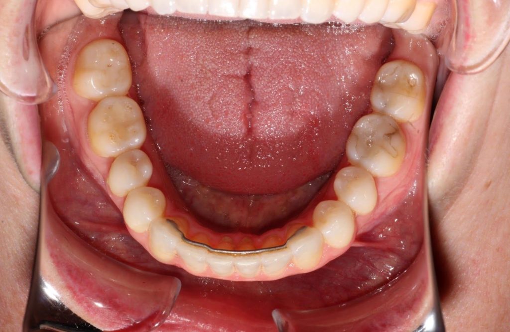 These clear, custom-shaped plastic aligners fit comfortably around all ...