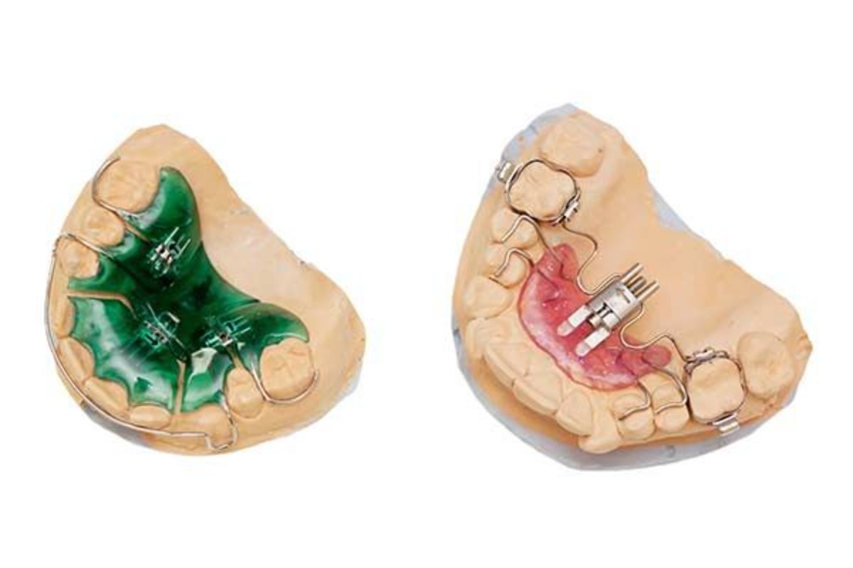 Adult Expanders For Teeth